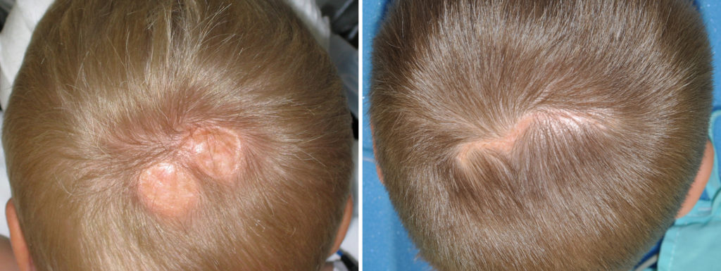 Plastic Surgery Case Study - Pediatric Scalp Reconstruction of Cutis ...