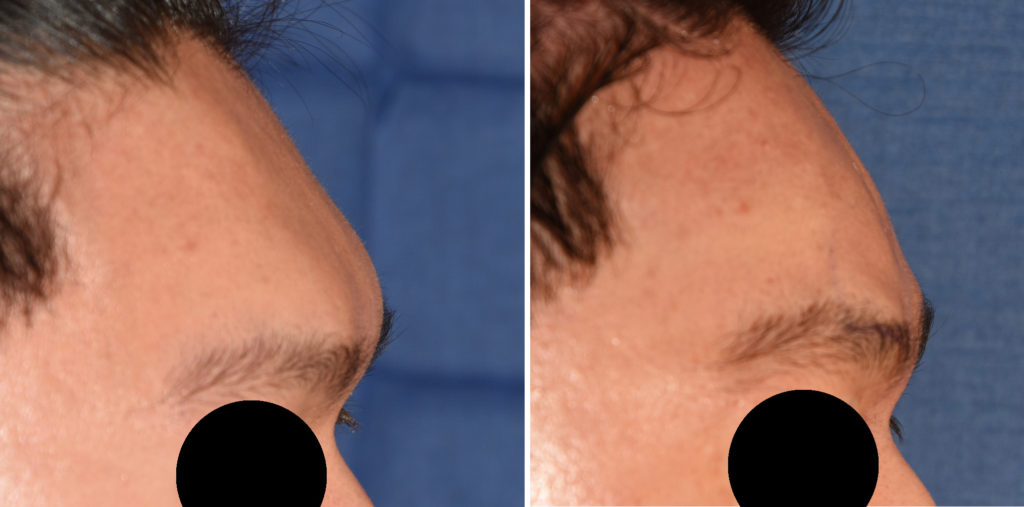 Plastic Surgery Case Study - Male Brow Bone Reduction by Bone Flap ...