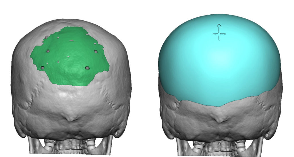 Plastic Surgery Case Study - Custom Skull Implant Replacement of ...
