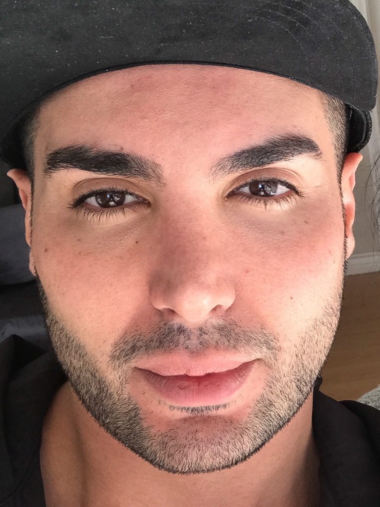 Plastic Surgery Case Study - Custom Chin Implant for 3D Lengthening and ...