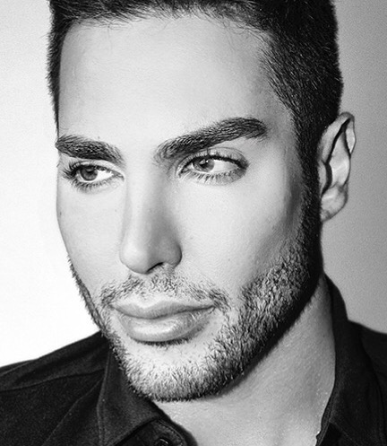 custom square chin implant with buccal lipectomies after dr barry ...