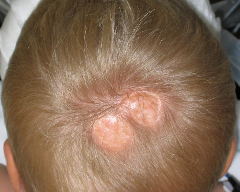 cutis aplasia of scalp dr barry eppley indianapolis - Explore Plastic ...