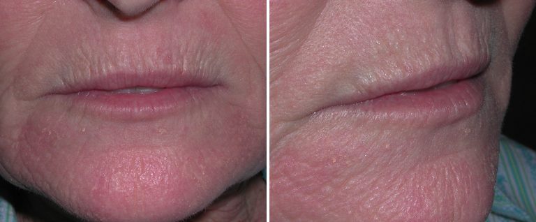 Plastic Surgery Case Study - Lip Advancements for Thin Lips with Deep ...