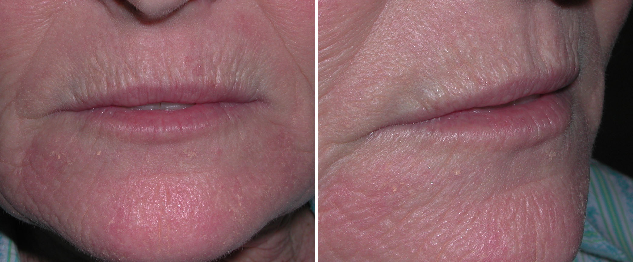 Aging Lips Dr Barry Eppley Indianapolis - Explore Plastic Surgery