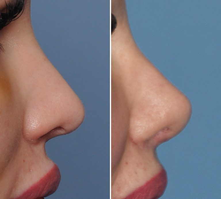 The Barbie Nose Rhinoplasty - Explore Plastic Surgery