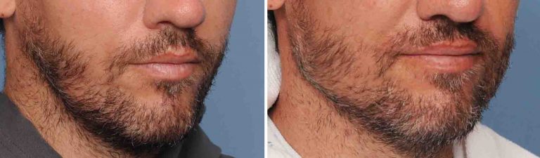 Plastic Surgery Case Study - Custom Widening Jaw Angle Implants ...