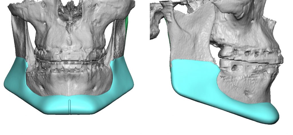 Plastic Surgery Case Study - Custom Jawline Implant Designs ...