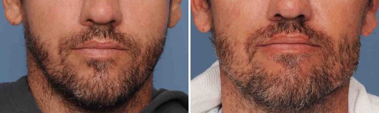 Plastic Surgery Case Study - Custom Widening Jaw Angle Implants ...
