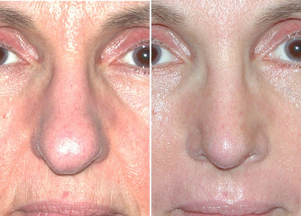 Nasal Tip Projection and the Nasolabial Angle in Rhinoplasty - Explore ...