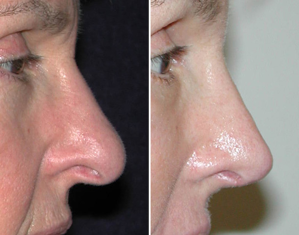 Plastic Surgery Case Study - Early Nasal Swelling After Rhinoplasty ...