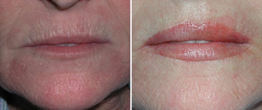 Plastic Surgery Case Study - Lip Advancements for Thin Lips with Deep ...