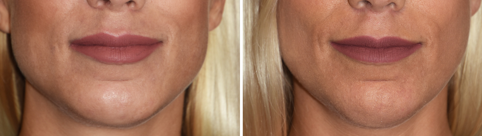 Plastic Surgery Case Study - Female Chin Implant Replacement for a More ...