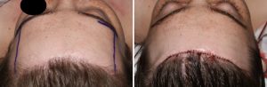 Reduction of the Anterior Temporal Line in Forehead Reshaping - Explore ...