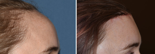 Frontal hairline advancement-forehead reduction result side view dr ...