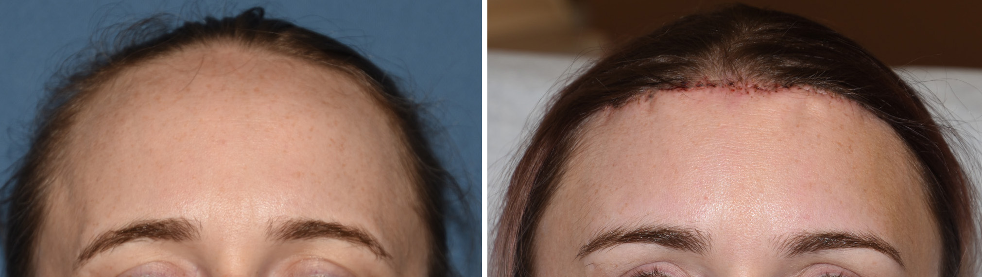 Plastic Surgery Case Study - Total Forehead Reshaping in a Female with ...