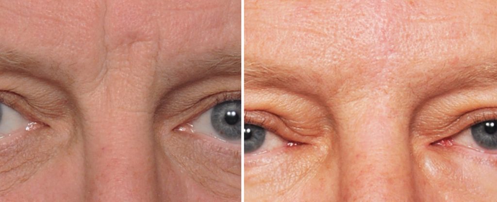 Plastic Surgery Case Study - Deep Glabellar Furrow Reconstruction with ...