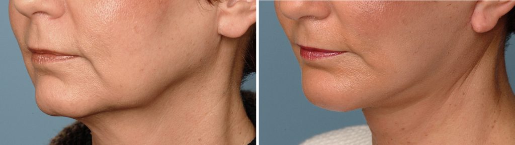 A Study of the MACS Facelift - Explore Plastic Surgery