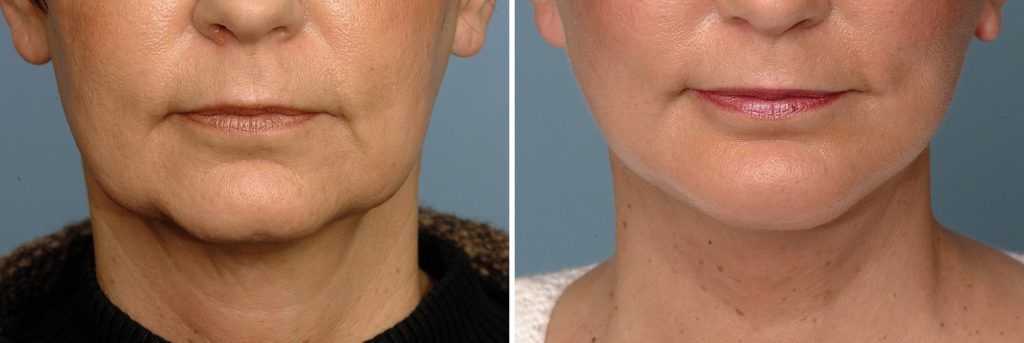 Plastic Surgery Case Study - The Value of Chin Augmentation in Facelift ...
