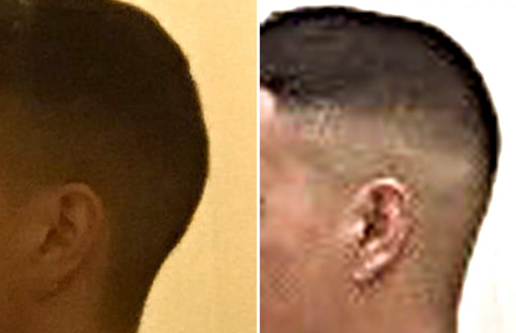 Occipital Skull Reduction - Reducing the Protusion on the Back of the ...