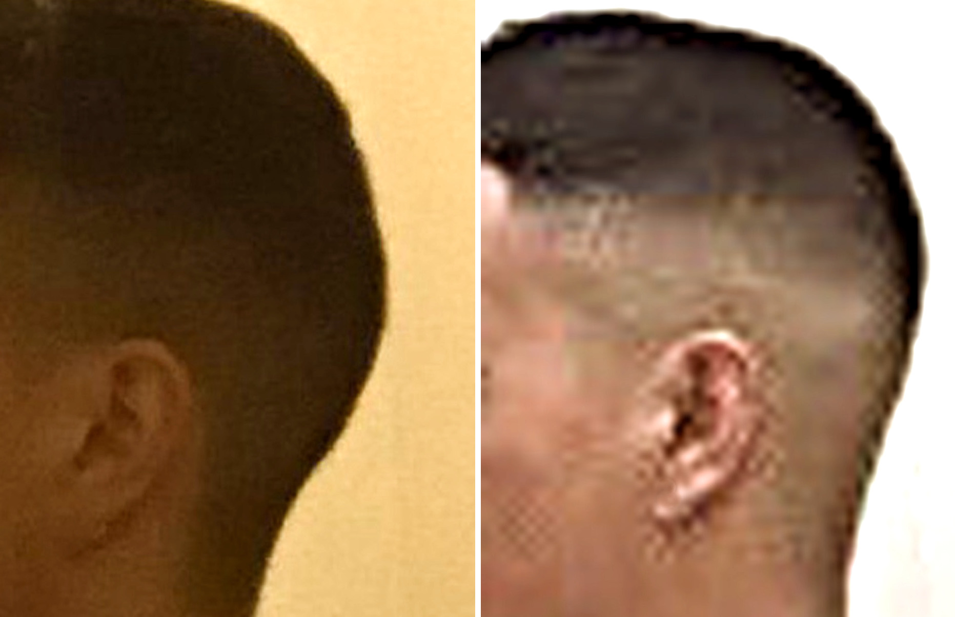 Occipital Skull Reduction - Reducing the Protusion on the Back of the ...