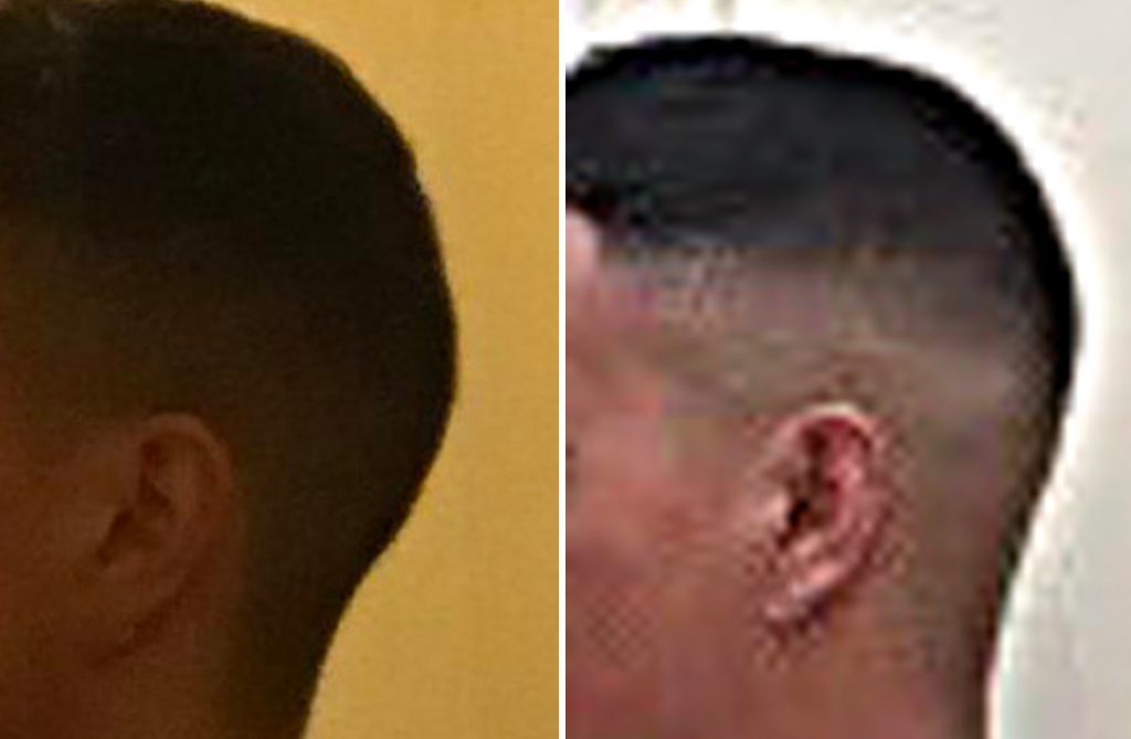 Occipital Skull reduction result Dr Barry Eppley Indianapolis - Explore ...