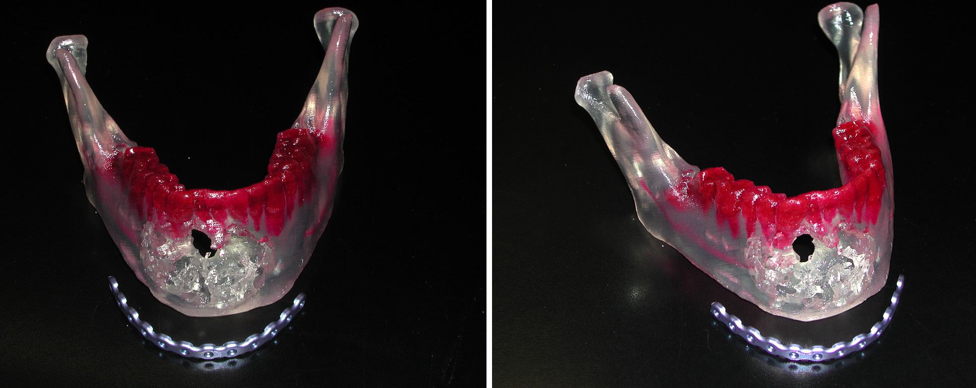 Plate Bending on Anatomical Models of Jaw Cyst Dr Barry Eppley ...