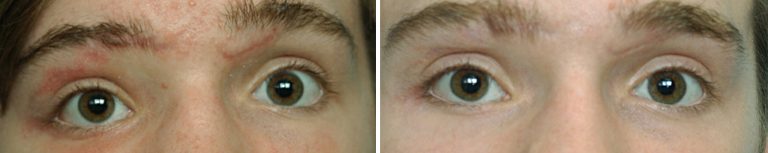 Plastic Surgery Case Study - Post Traumatic Vertical Orbital Dystopia ...