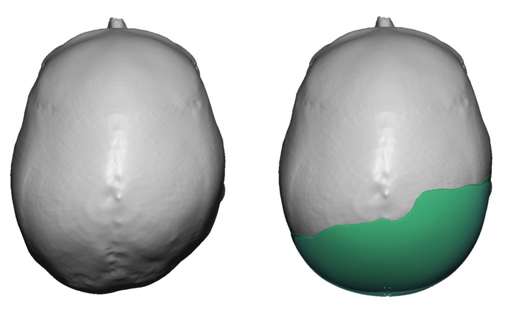 Plastic Surgery Case Study - Custom Occipital Skull Implant Replacement ...