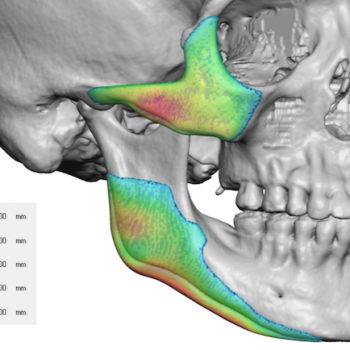 Plastic Surgery Case Study - Facial Asymmetry Surgery with Custom Cheek ...