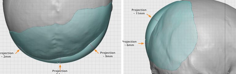 Plastic Surgery Case Study - Custom Occipital Skull Implant Replacement ...