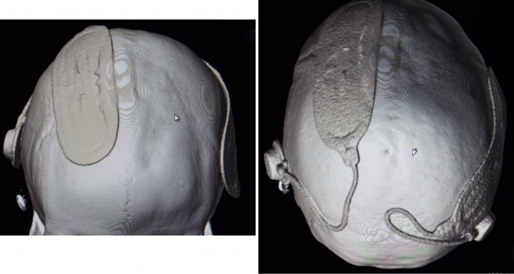 Plastic Surgery Case Study - Scalp Reconstruction in Parry-Romberg's Disease - Explore Plastic ...