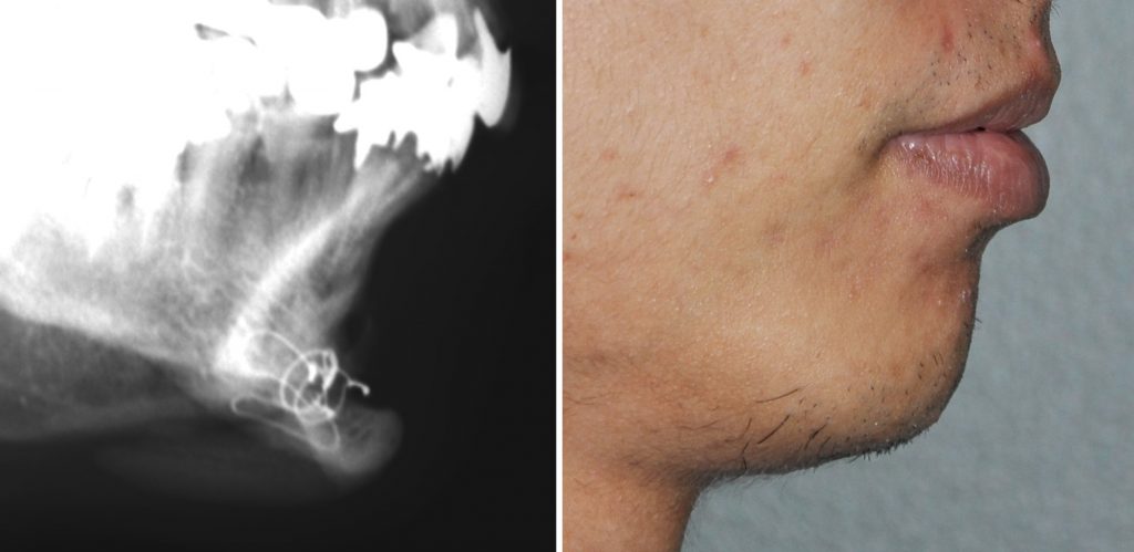 Plastic Surgery Case Study - Secondary Vertical Chin Lengthening with ...