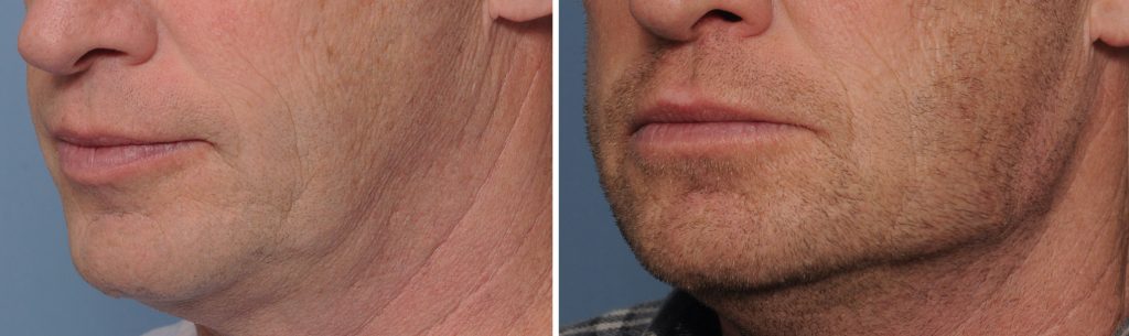Plastic Surgery Case Study - Standard Vertical Lengthening Jaw Angle ...