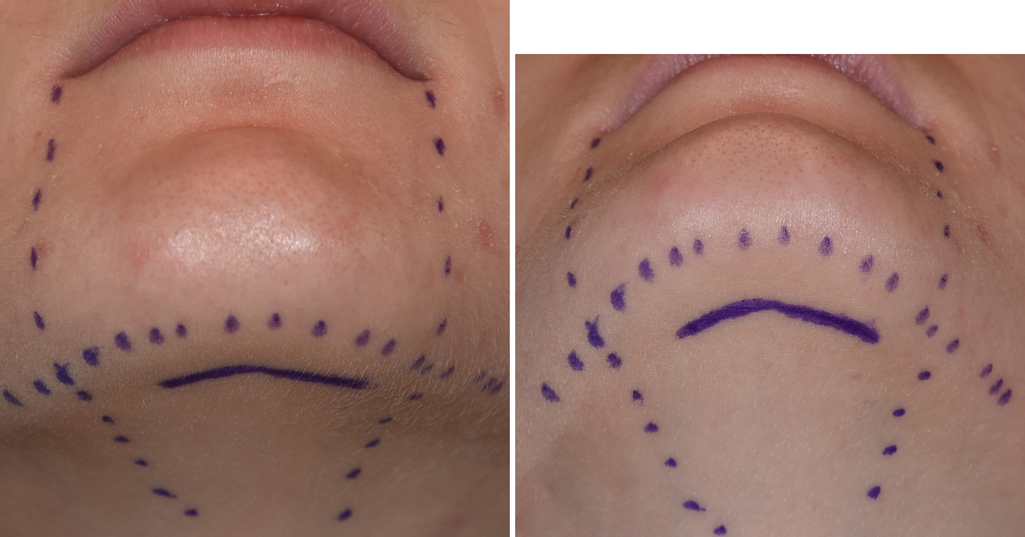 Submental Chin reduction preop markings Dr Barry Eppley Indianapolis ...