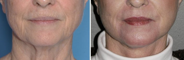 Plastic Surgery Case Study - The Added Benefits of Perioral Laser ...