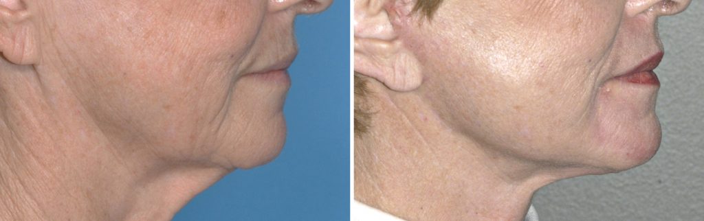 Plastic Surgery Case Study - The Added Benefits of Perioral Laser ...