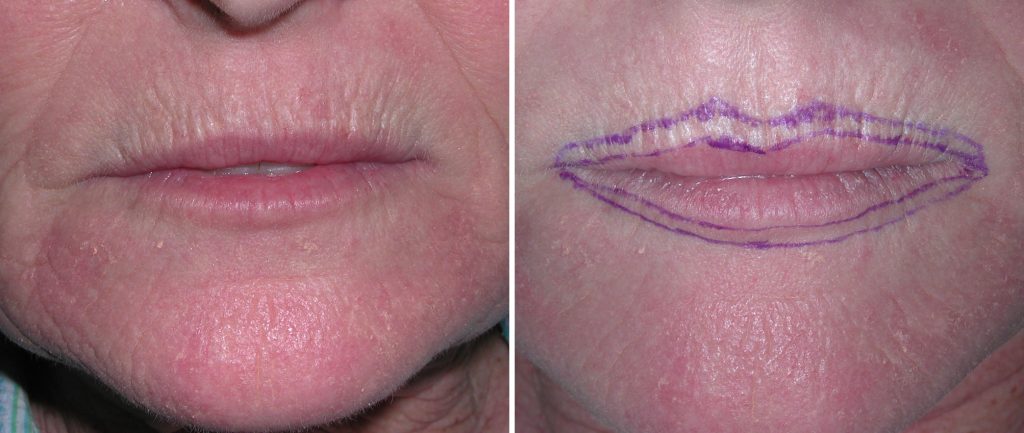 Plastic Surgery Case Study - Lip Advancements for Thin Lips with Deep ...