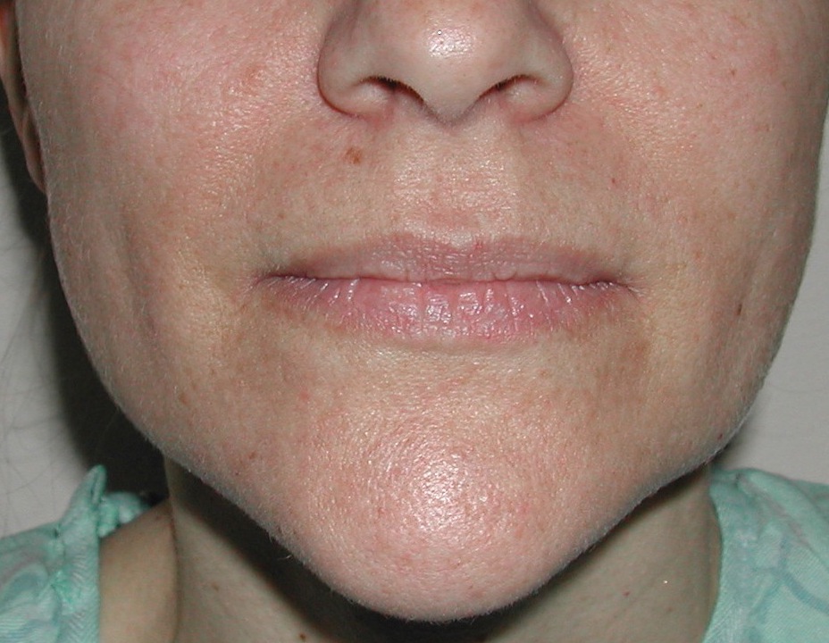 female masseter muscle reduction with Botox after dr barry eppley ...