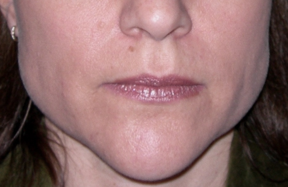 female masseter muscle reduction with Botox before dr barry eppley ...