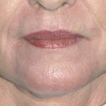 The Effectiveness of the Erbium Laser for Perioral Wrinkle Reduction ...