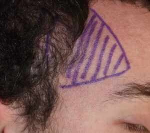 Anterior vs Posterior Temporal Reduction for Head Width Narrowing ...