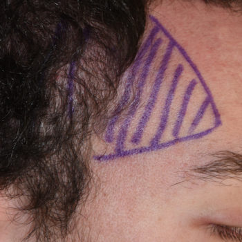 temporal reduction Archives - Page 4 of 6 - Explore Plastic Surgery