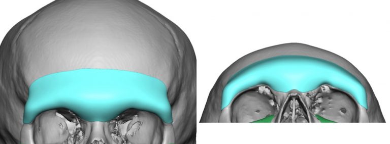 Plastic Surgery Case Study - Three Incisional Placement Technique for ...