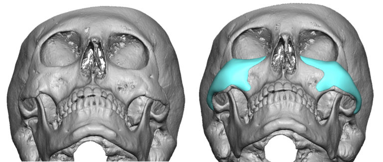 Custom Infarorbital-Malar Implants (male model look) submental view Dr ...