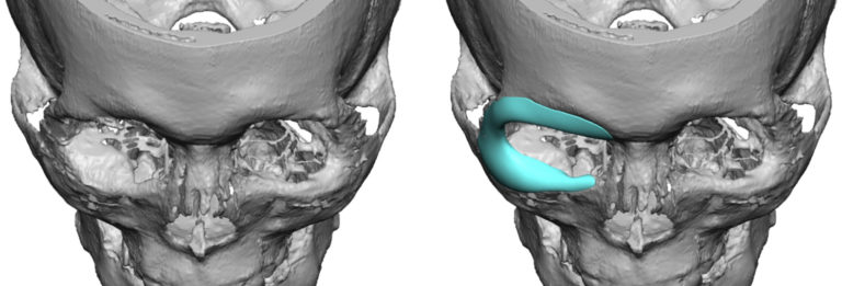 Custom Right Orbital Implant for Asymmetry design top view Dr Barry ...