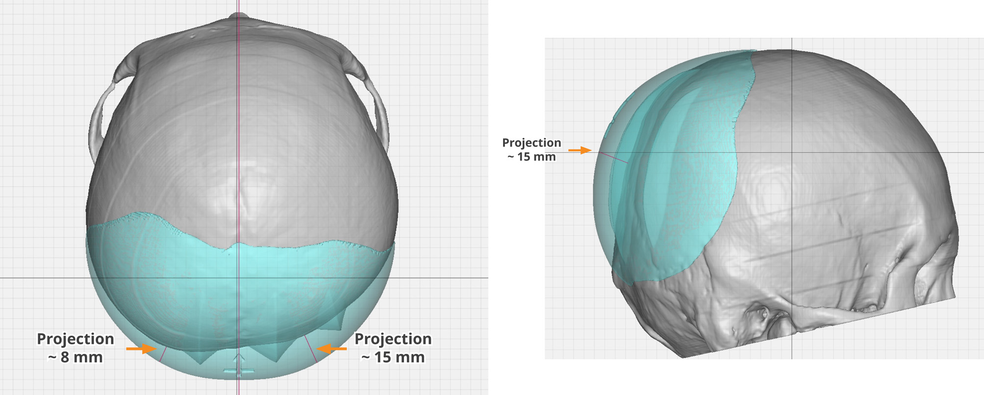 Plastic Surgery Case Study - Custom Occipital Skull Implant for Adult ...