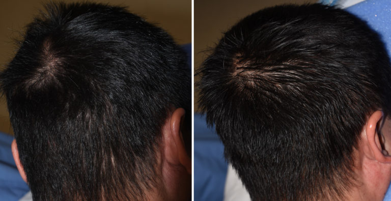 Plastic Surgery Case Study - Custom Occipital Skull Implant for Adult ...