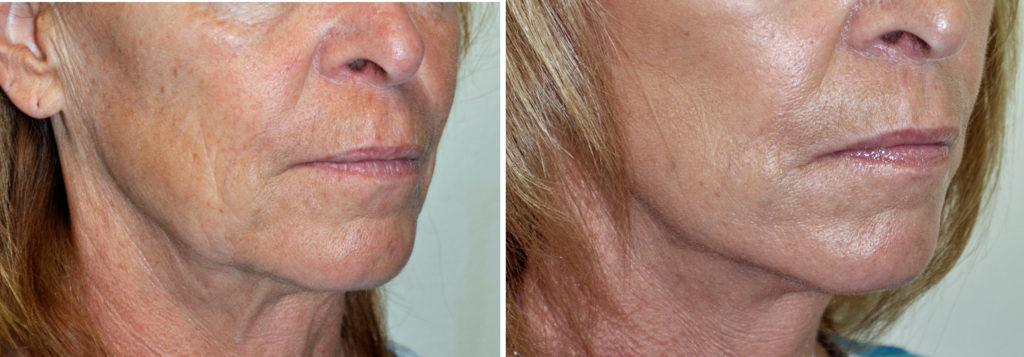 Plastic Surgery Case Study - The Level 1 Facelift (Jowl Tuckup ...