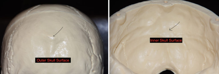 Plastic Surgery Case Study - The Minimal Incision Approach to Occipital ...