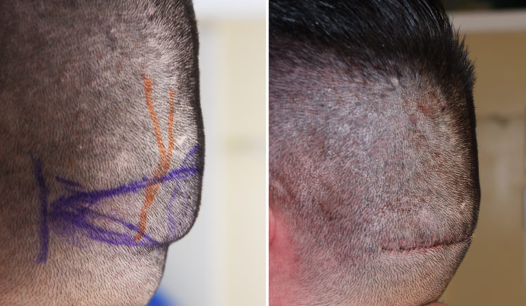 Plastic Surgery Case Study - Combined Occipital Knob Skull Reduction ...